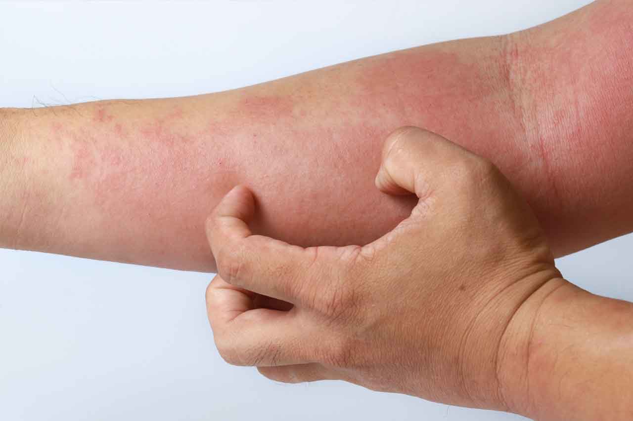 Atopic dermatitis (eczema) truth - Host and Care Medical Journal